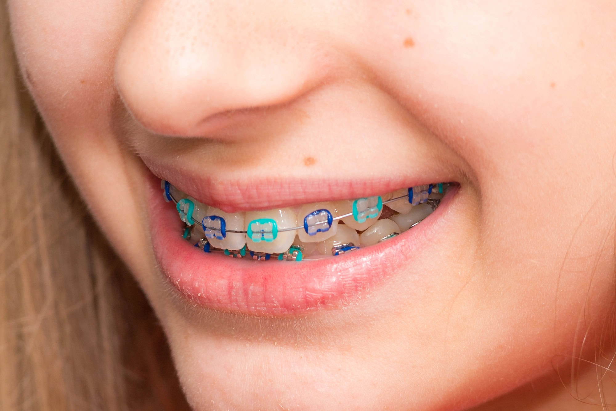 How Much Do Braces Cost for Kids? Average Price in 2025 ...